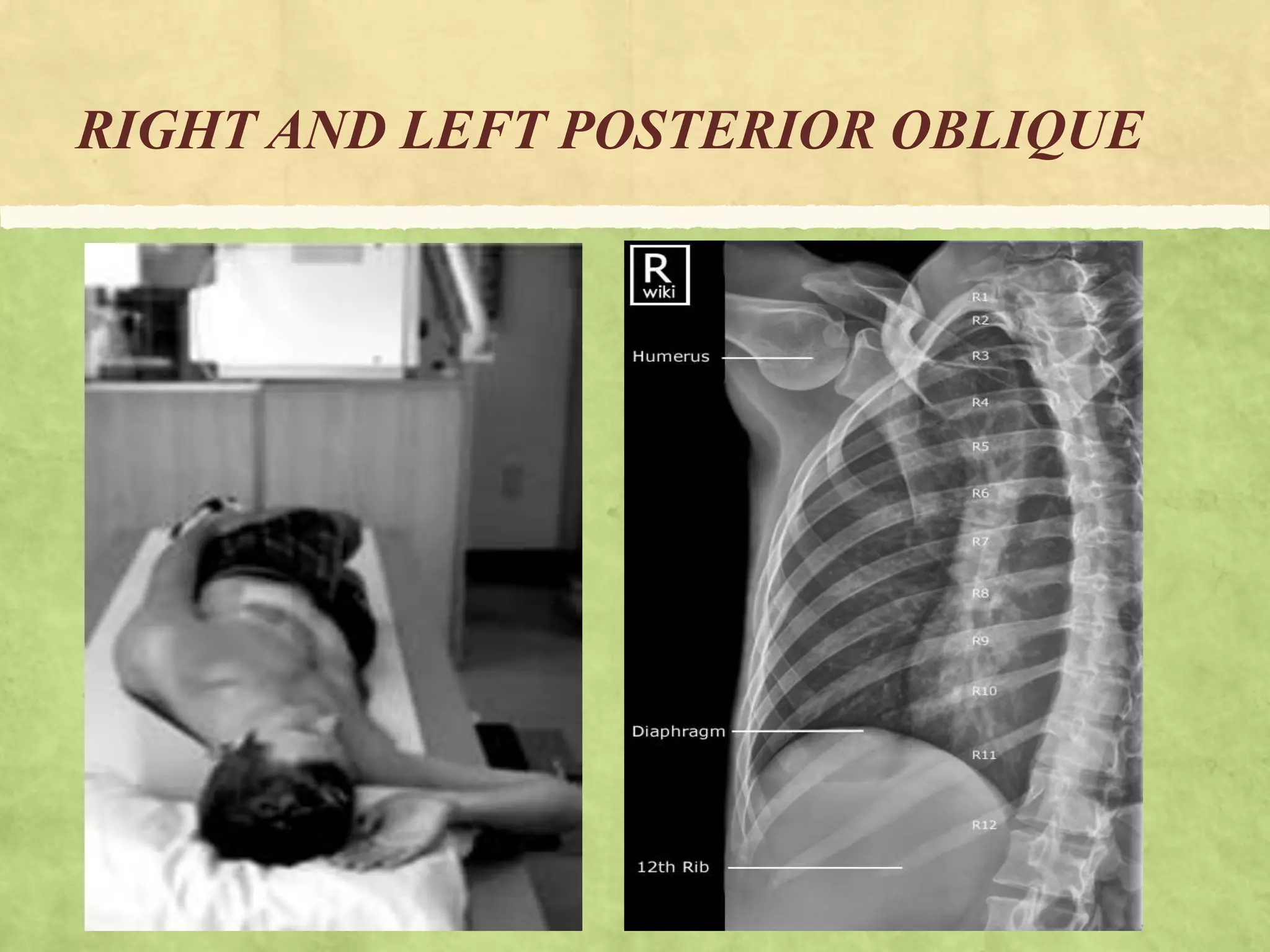 RIBS AND STERNUM RADIO-GRAPHIC PROJECTIONS | PPTX