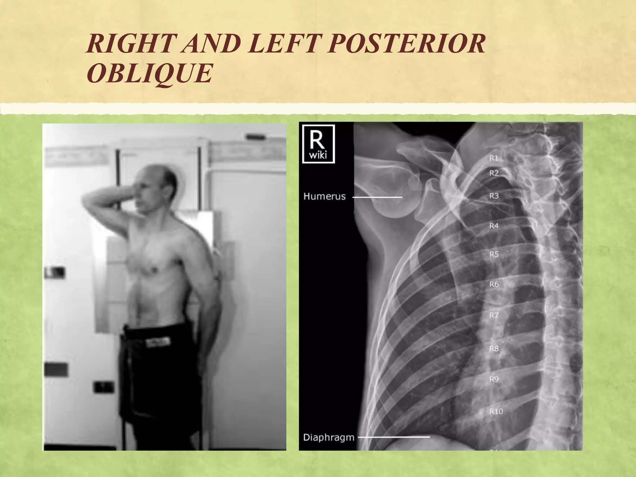 RIBS AND STERNUM RADIO-GRAPHIC PROJECTIONS | PPTX