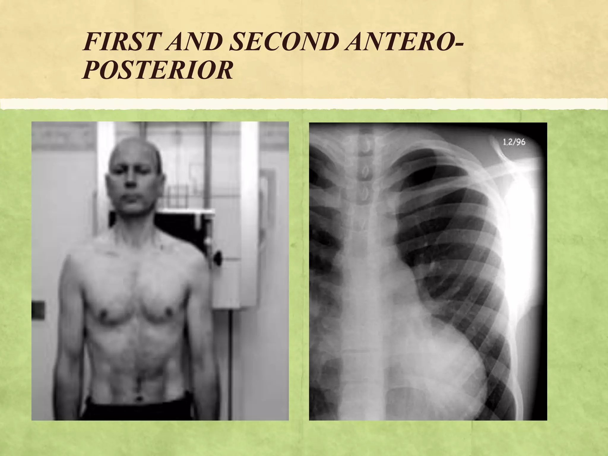 RIBS AND STERNUM RADIO-GRAPHIC PROJECTIONS | PPTX