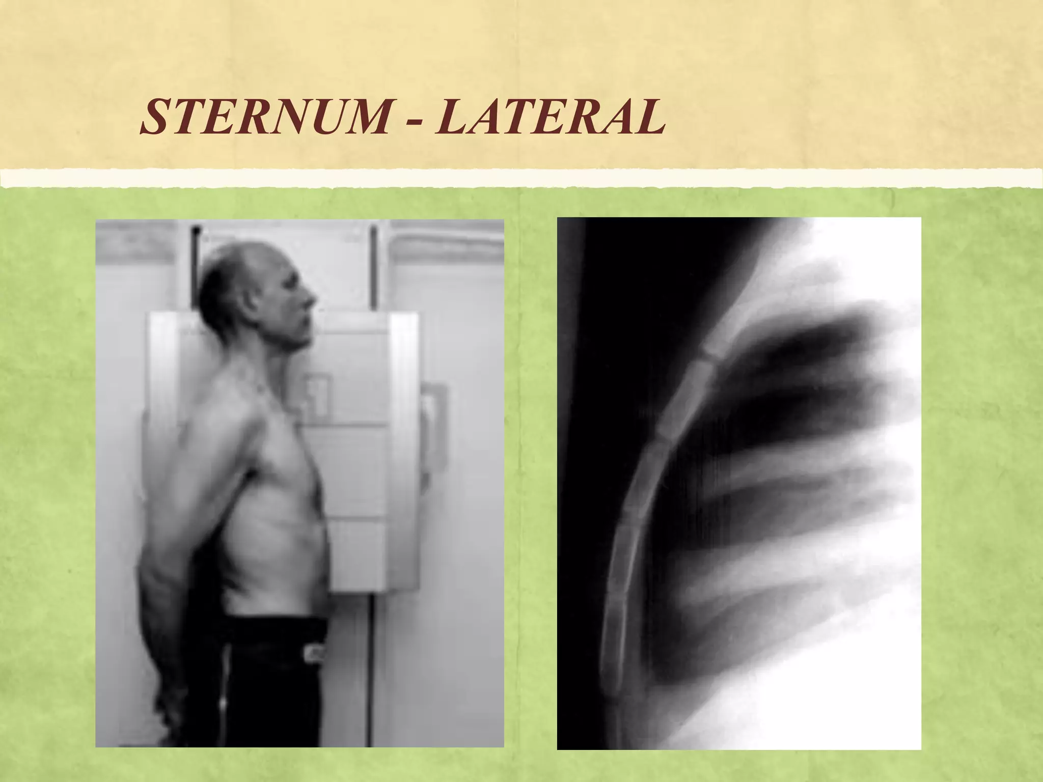 RIBS AND STERNUM RADIO-GRAPHIC PROJECTIONS | PPTX