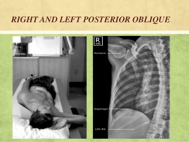 RIBS AND STERNUM RADIO-GRAPHIC PROJECTIONS