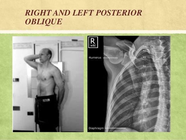 RIBS AND STERNUM RADIO-GRAPHIC PROJECTIONS
