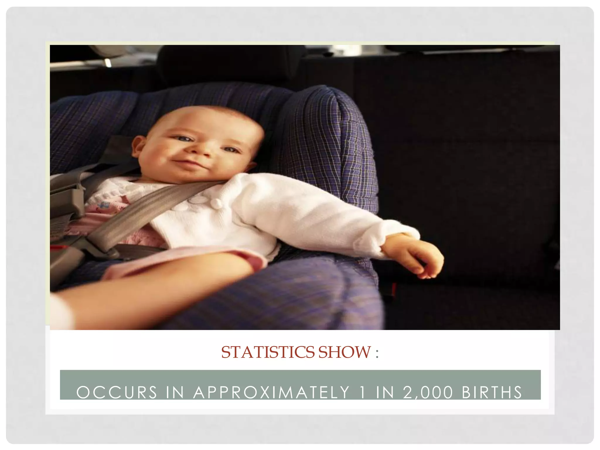 Velo cardio facial syndrome | PPTX