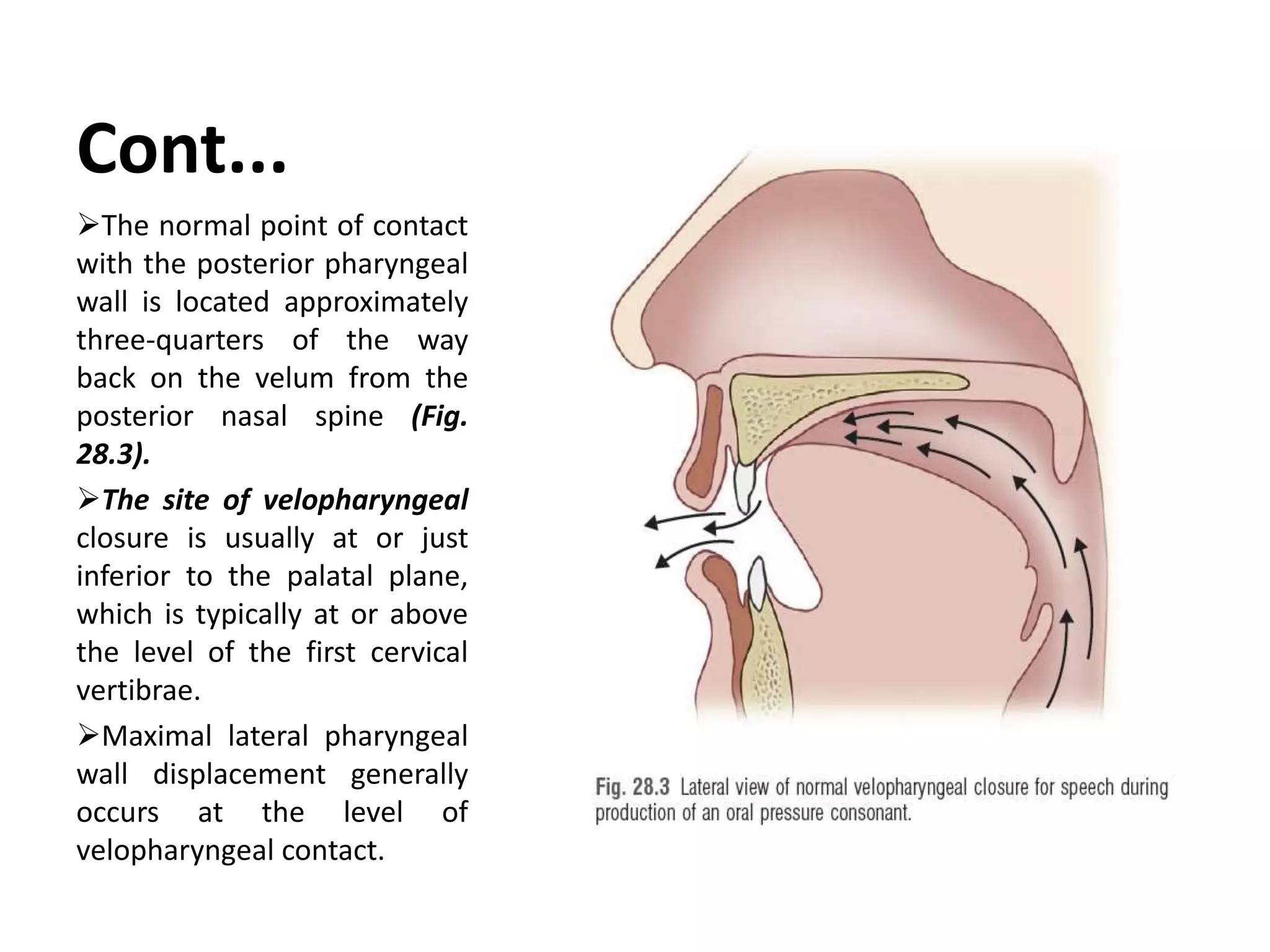 Velopharyngeal dysfunction (VPD) | PPTX