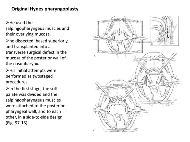 Velopharyngeal dysfunction (VPD) | PPTX | Ear, Nose and Throat Conditions | Diseases and Conditions