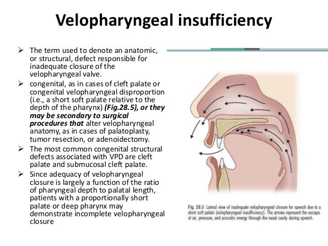 Velopharyngeal Closure