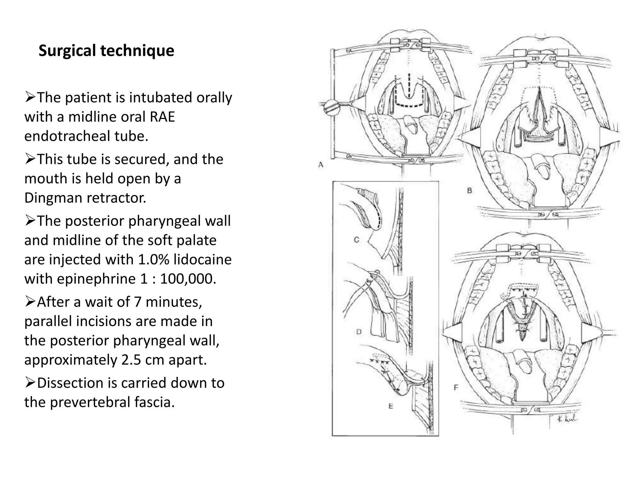 Velopharyngeal dysfunction | PPTX
