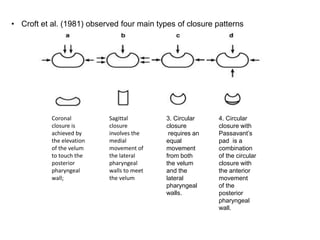 Velopharyngeal insufficiency parag | PPTX