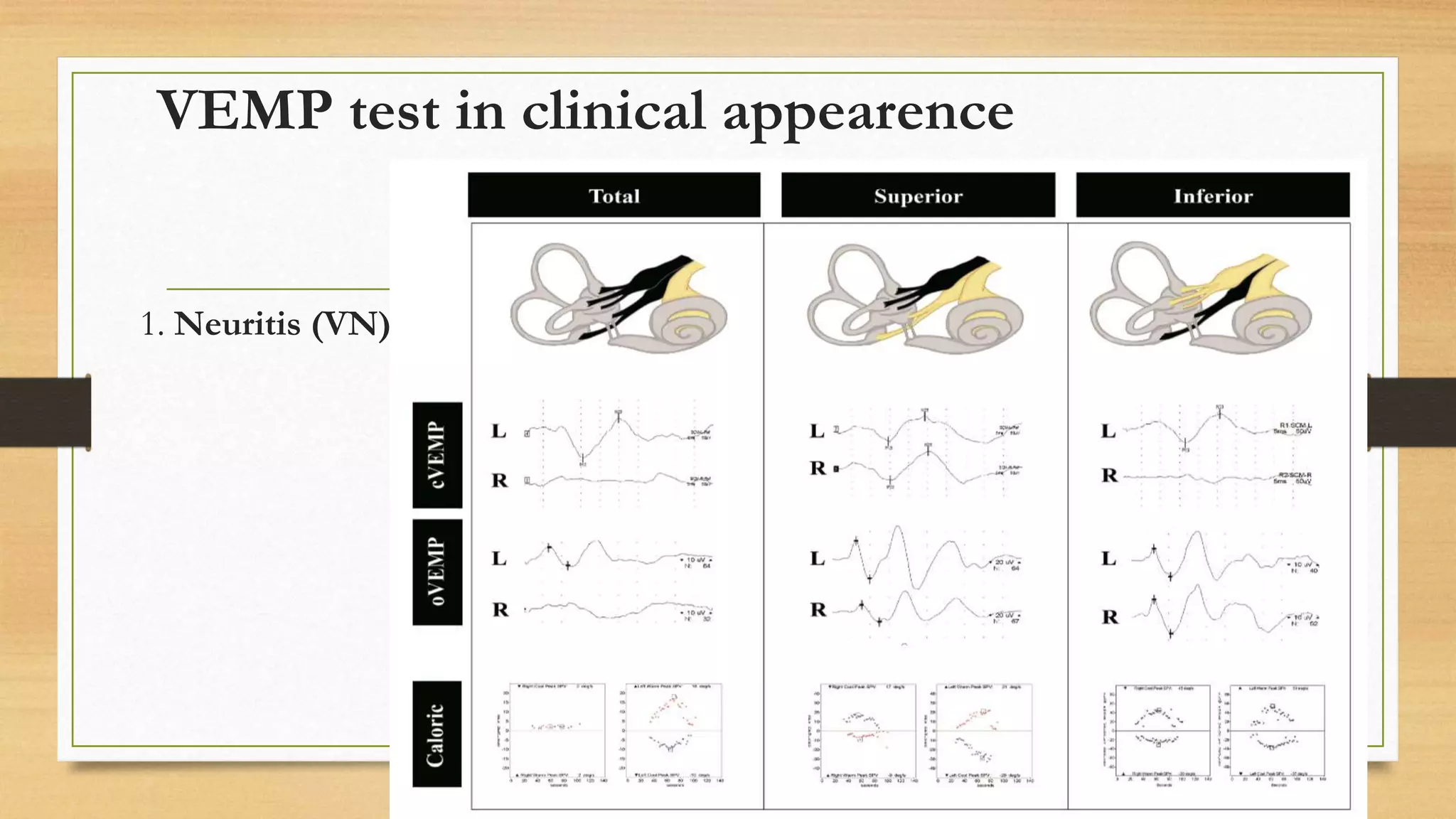 VEMP (PPT) Dr.dr.HR Yusa Herwanto, MKed(ORL-HNS), Sp.THTKL(K) | PPTX