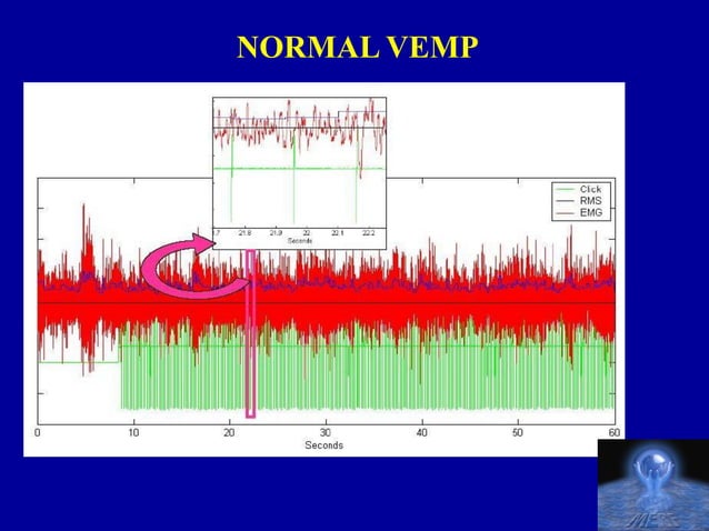 VEMP | PDF | Brain and Nervous System Disorders | Diseases and Conditions