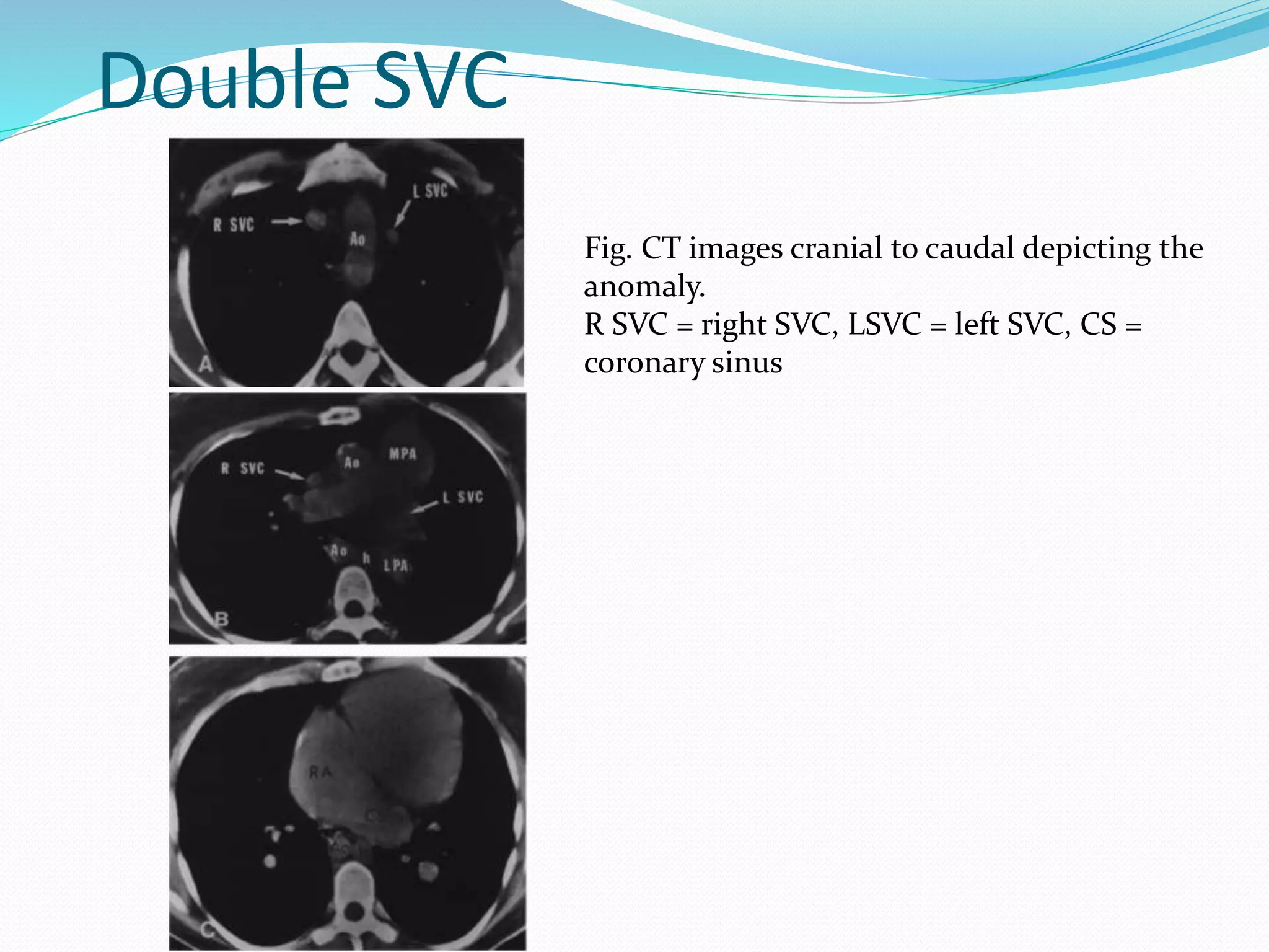 Vena cava anatomy and variants | PPTX