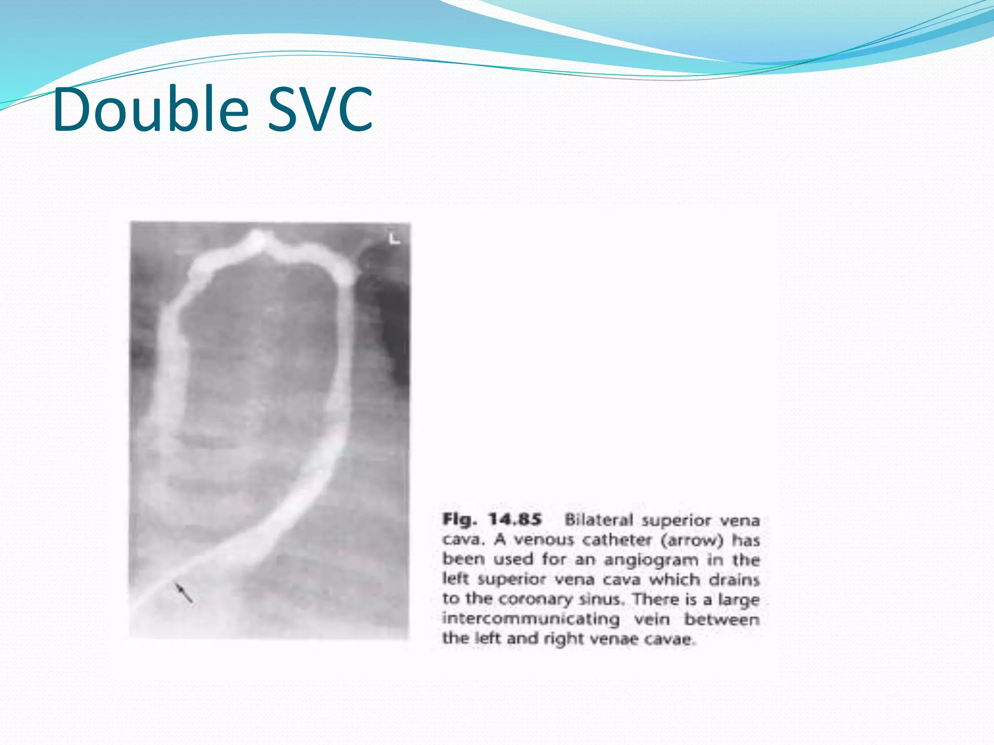 Vena cava anatomy and variants | PPTX