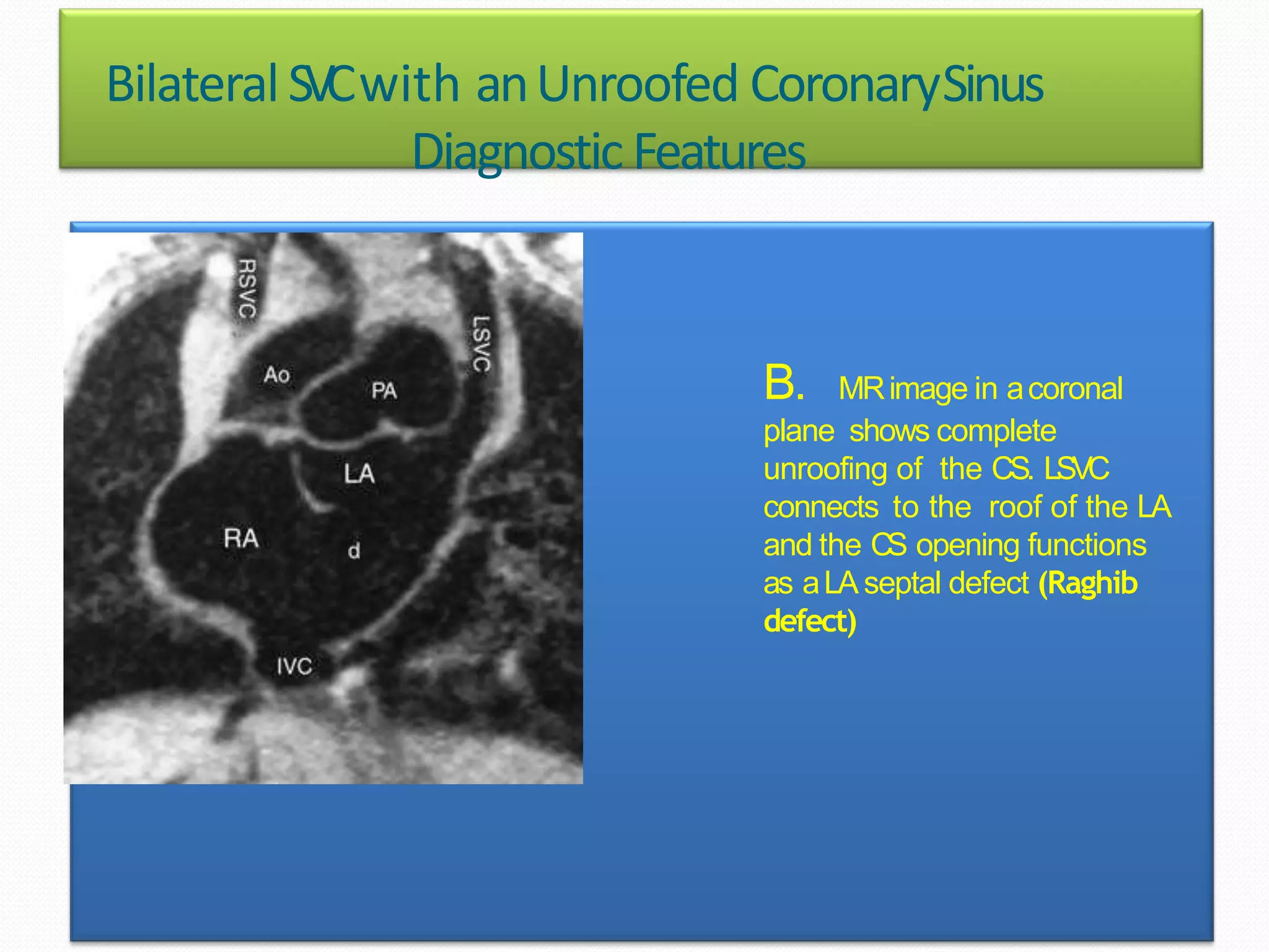 Vena cava anatomy and variants | PPTX