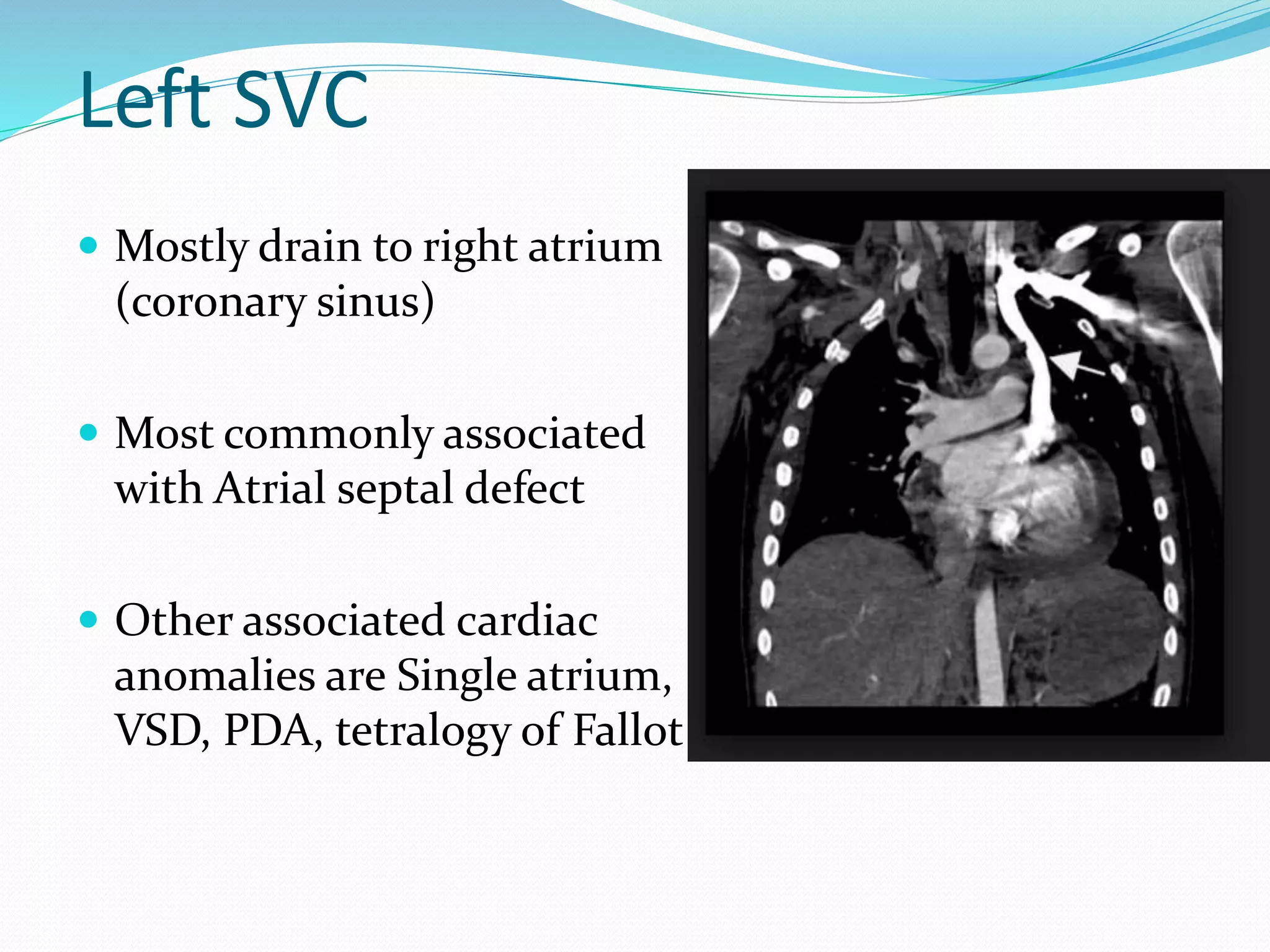 Vena cava anatomy and variants | PPTX