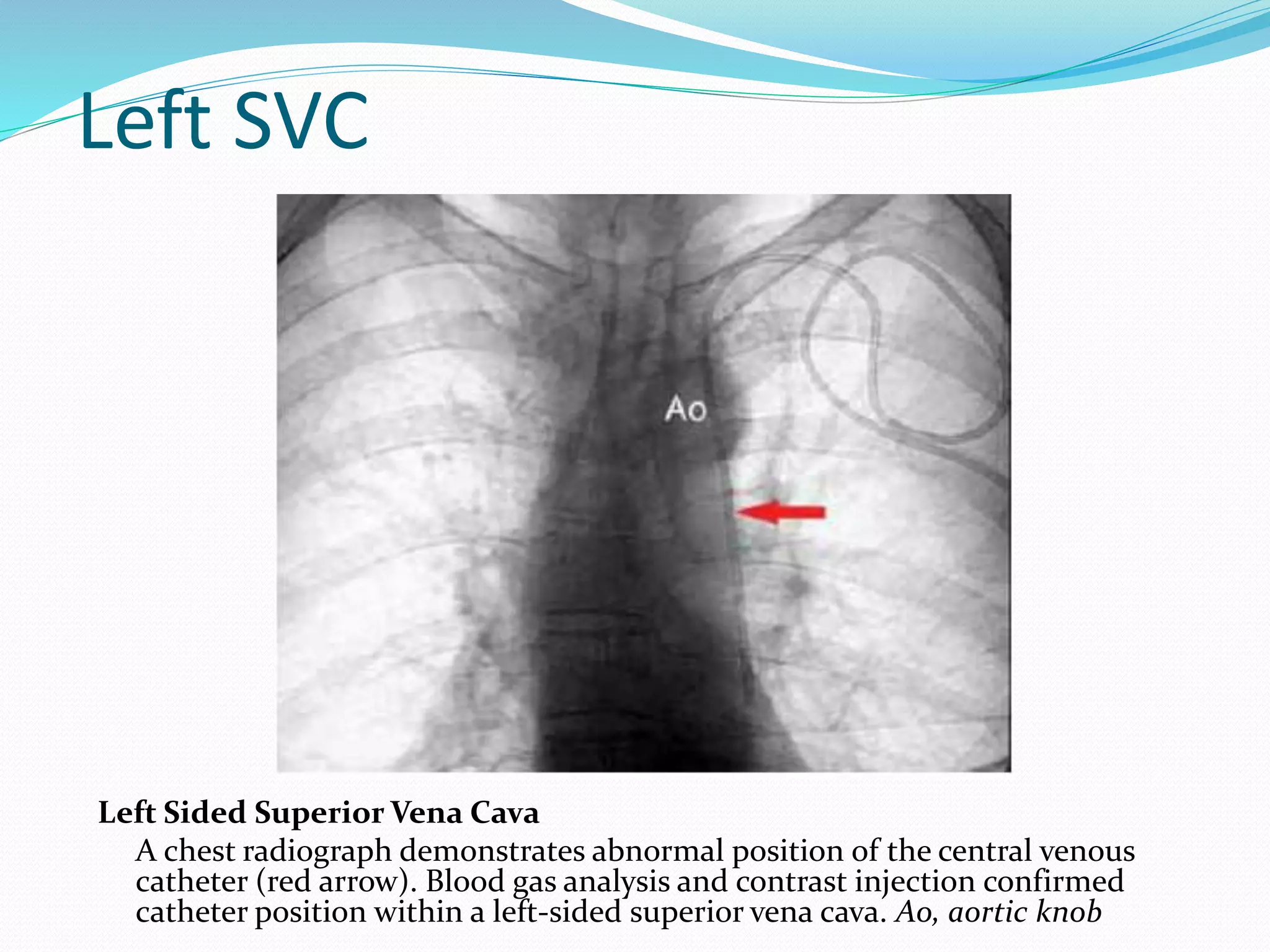 Vena cava anatomy and variants | PPTX