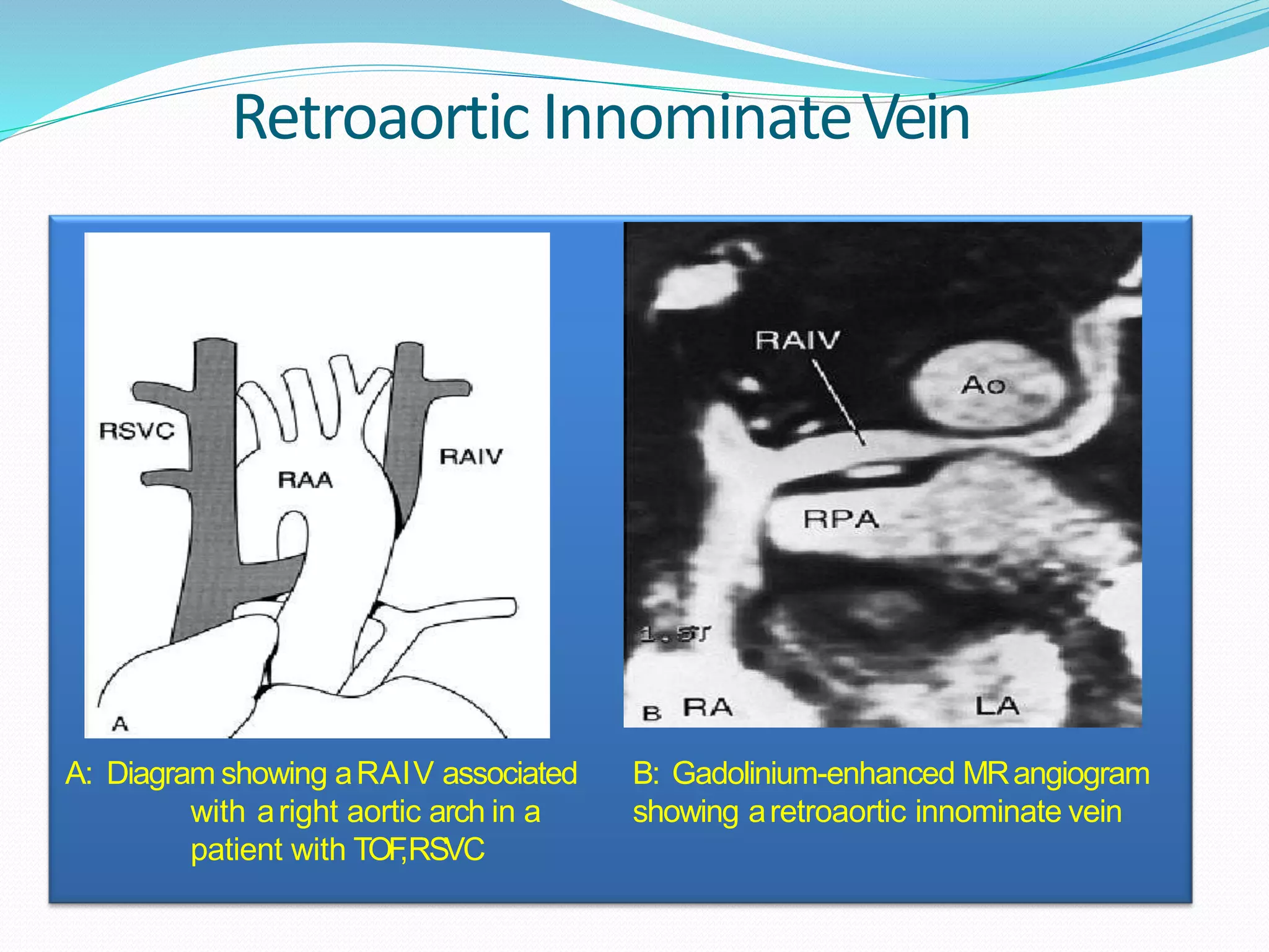 Vena cava anatomy and variants | PPTX