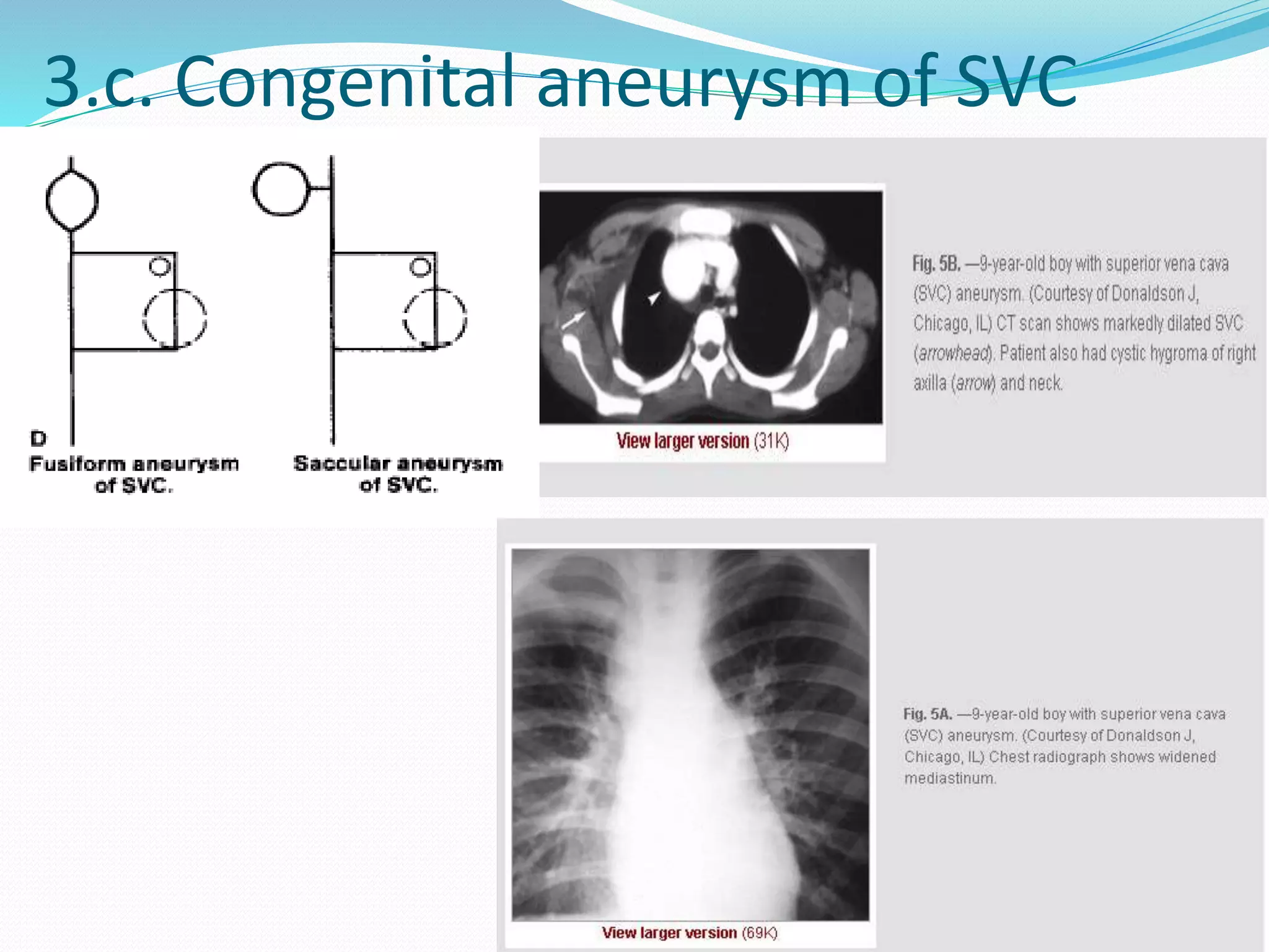 Vena cava anatomy and variants | PPTX