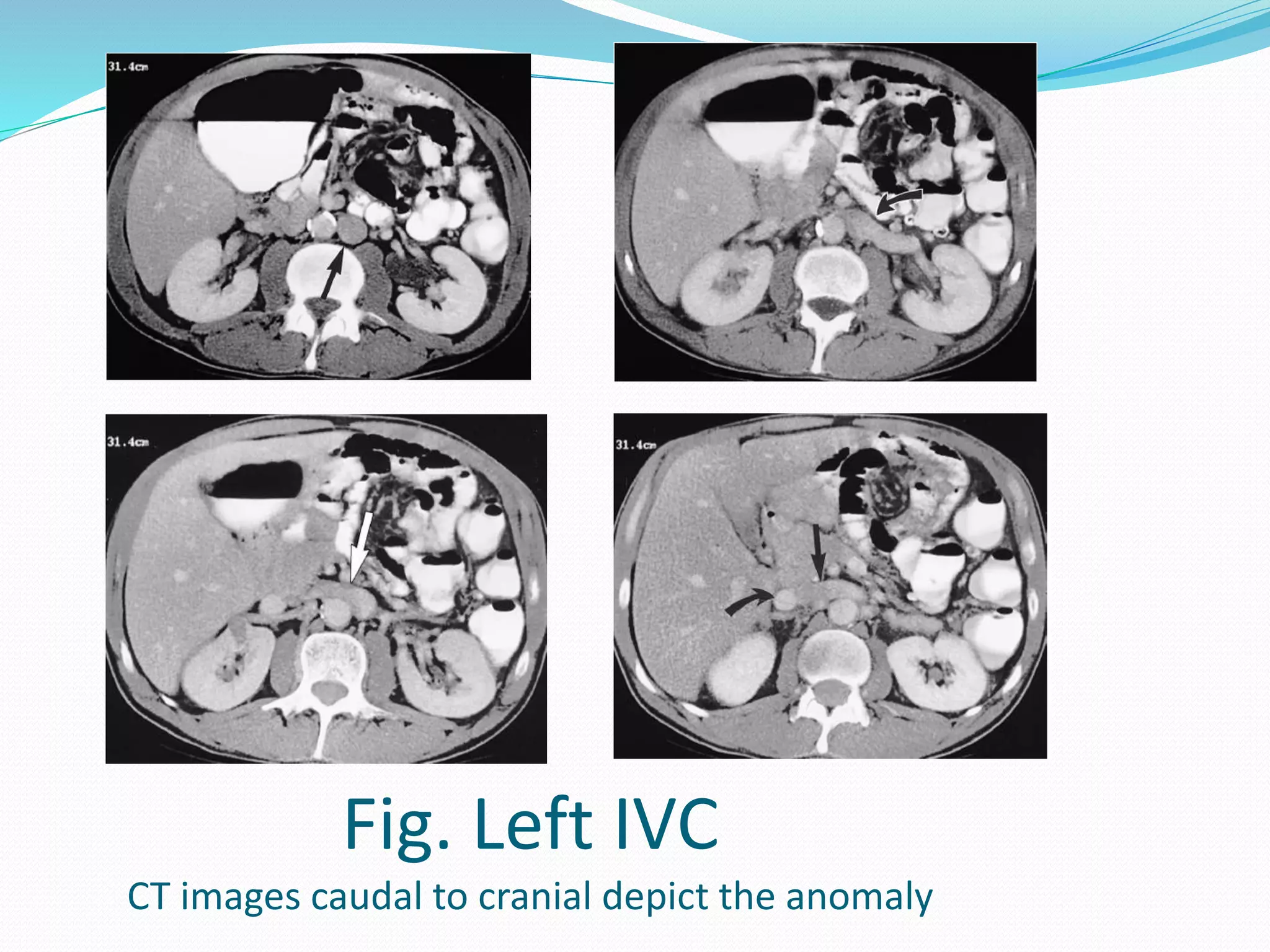 Vena cava anatomy and variants | PPTX