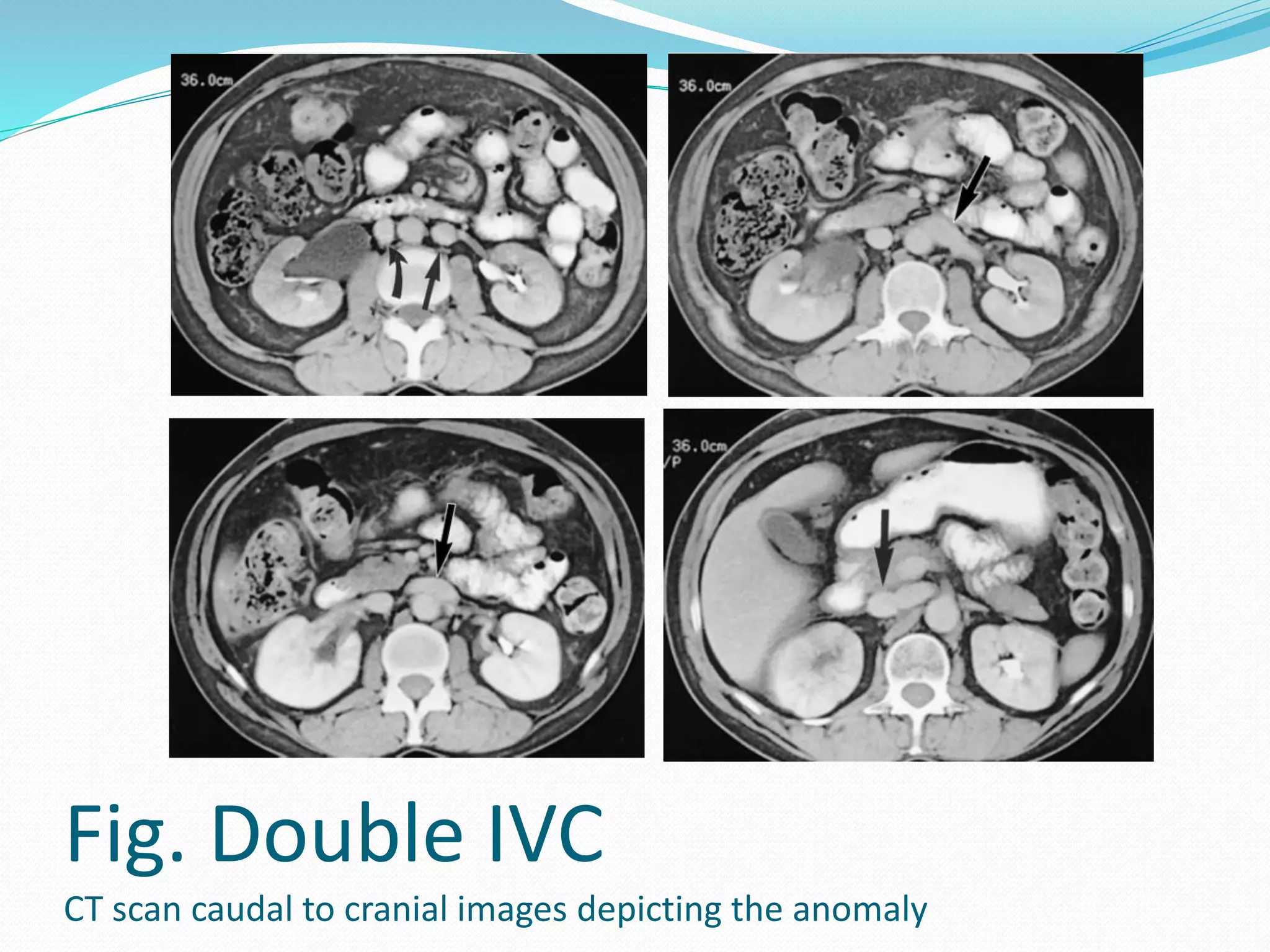 Vena cava anatomy and variants | PPTX