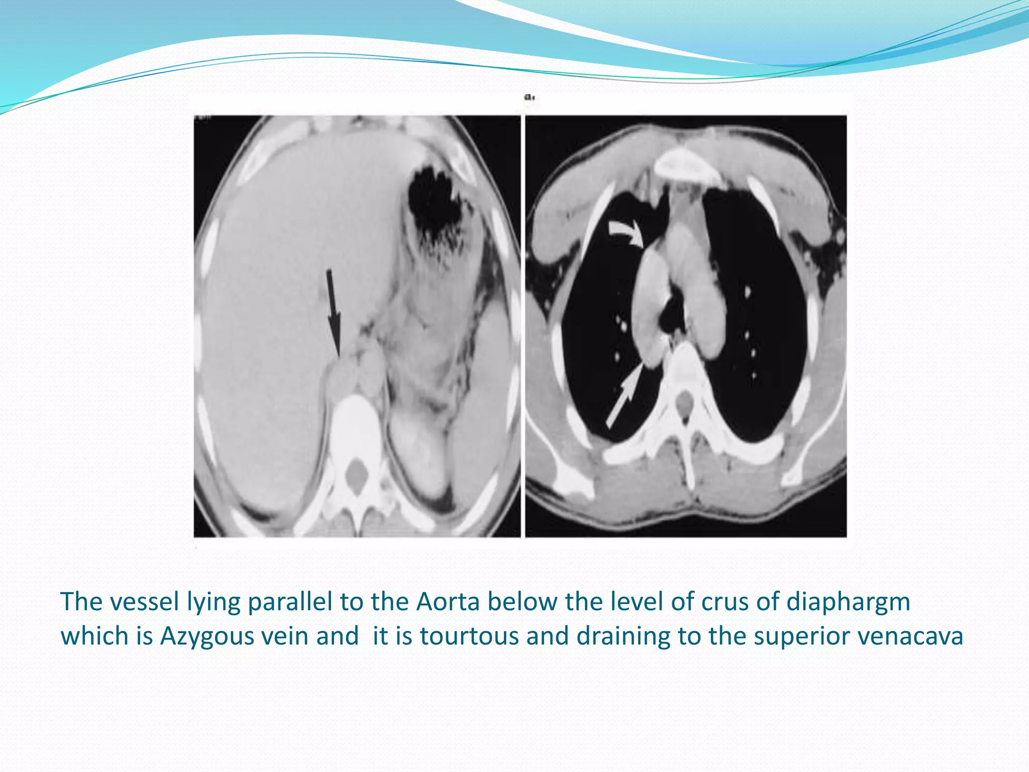 Vena cava anatomy and variants | PPTX