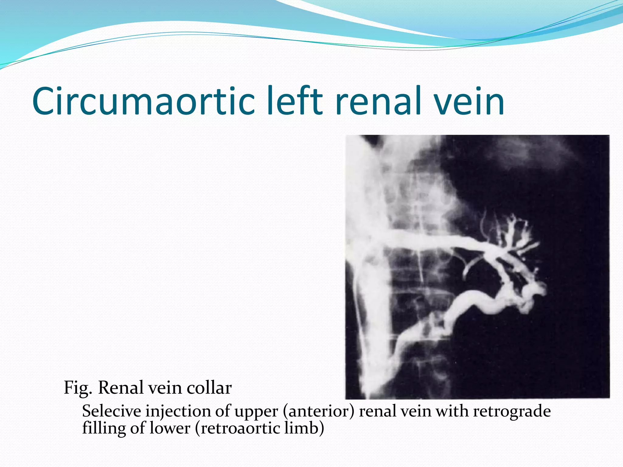 Vena cava anatomy and variants | PPTX