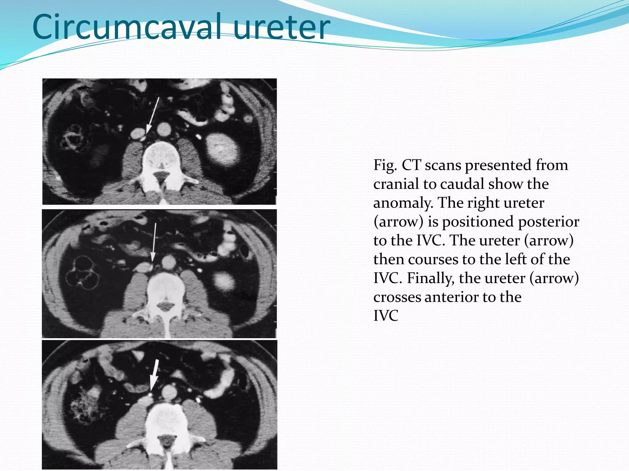Vena cava anatomy and variants | PPTX