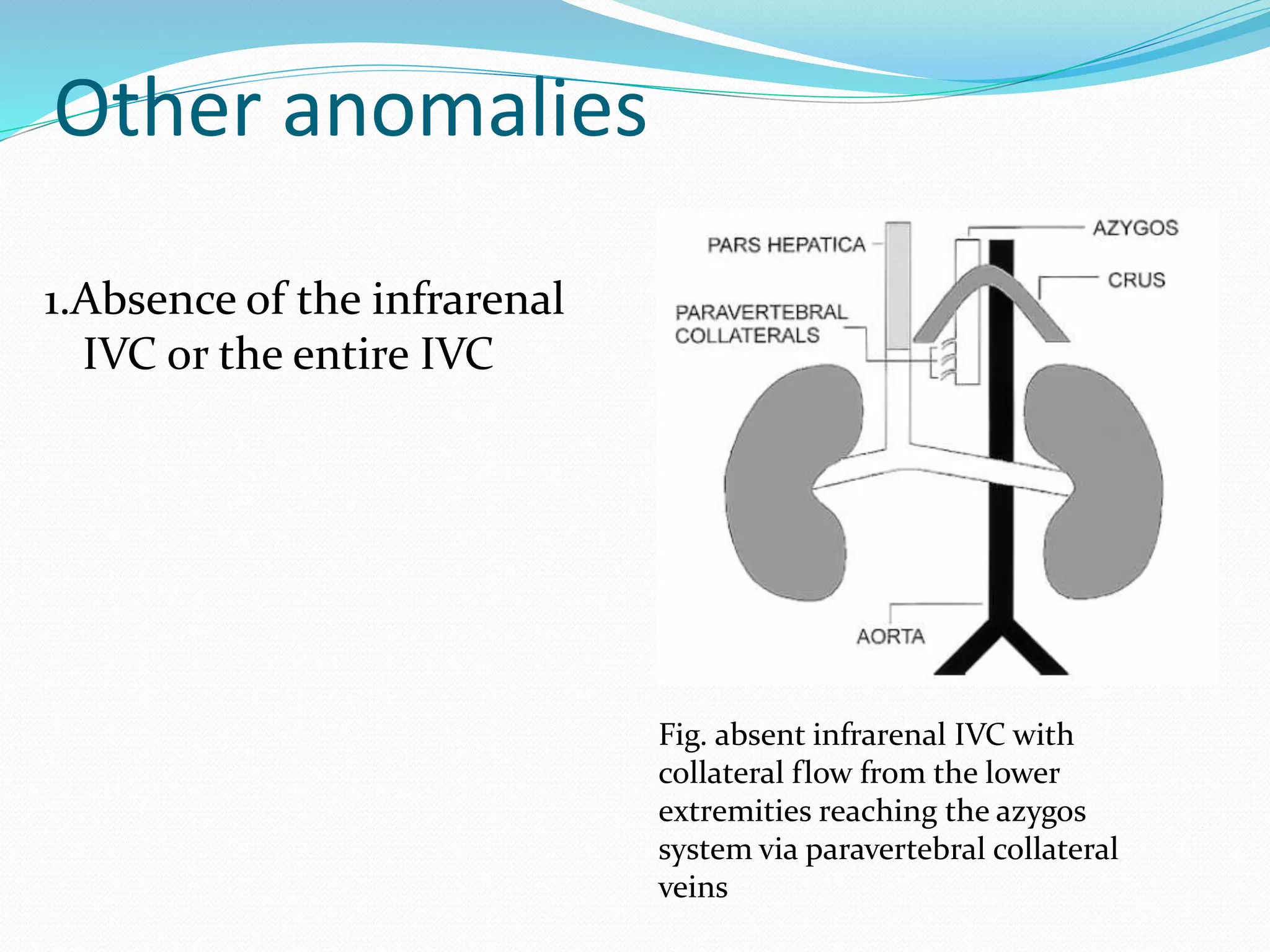 Vena cava anatomy and variants | PPTX