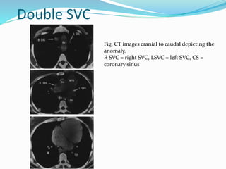 Vena cava anatomy and variants | PPTX