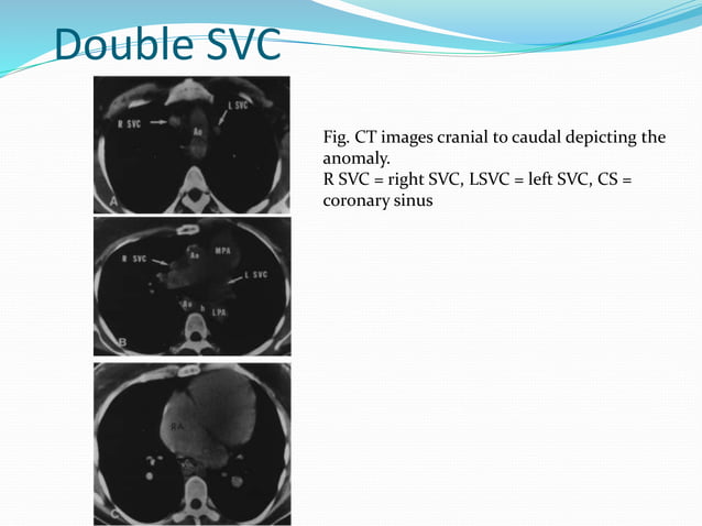 Vena cava anatomy and variants | PPTX | Pregnancy | Reproductive Health