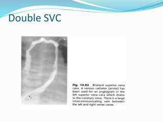 Vena cava anatomy and variants | PPTX