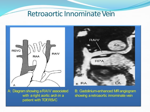 Vena cava anatomy and variants | PPTX | Pregnancy | Reproductive Health