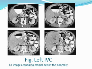 Vena cava anatomy and variants | PPTX