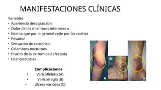 VENAS VARICOSAS_INSUFICIENCIA VENOSA CRONICA_TROMBOSIS VENOSA.pptx