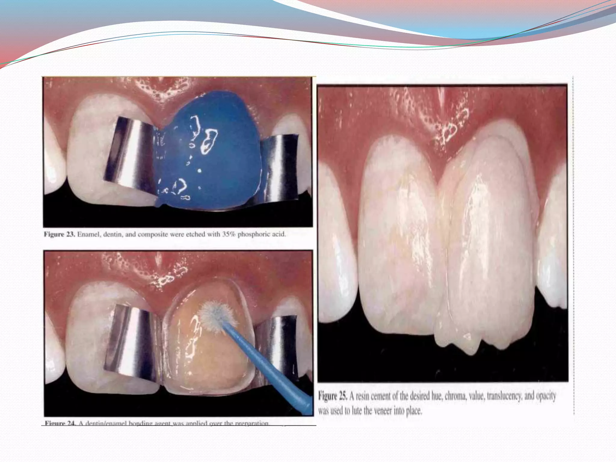 direct and indirect Veneer | PPTX