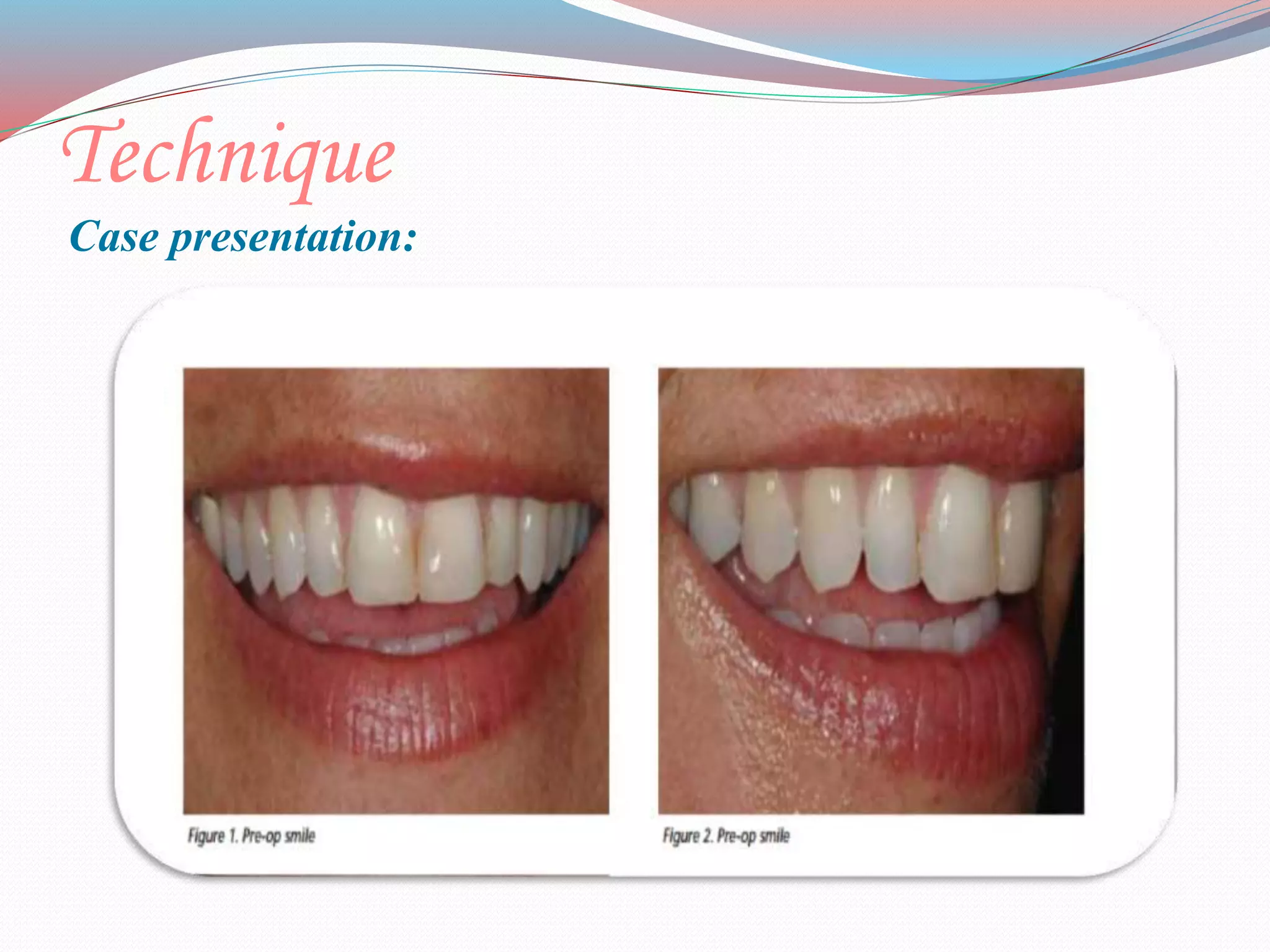 direct and indirect Veneer | PPTX