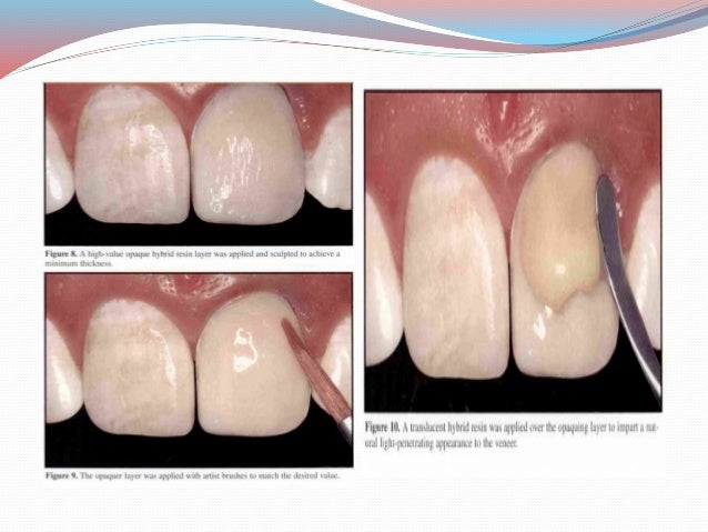 direct and indirect Veneer