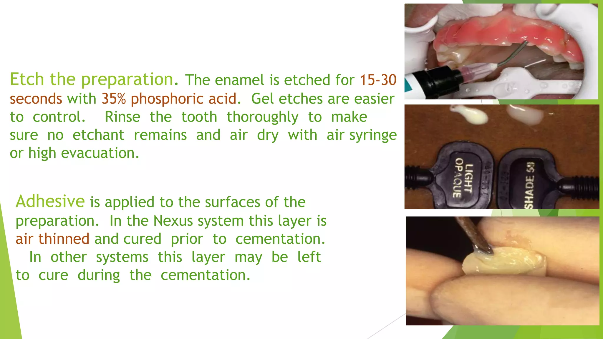 the Veneer step by step | PPTX