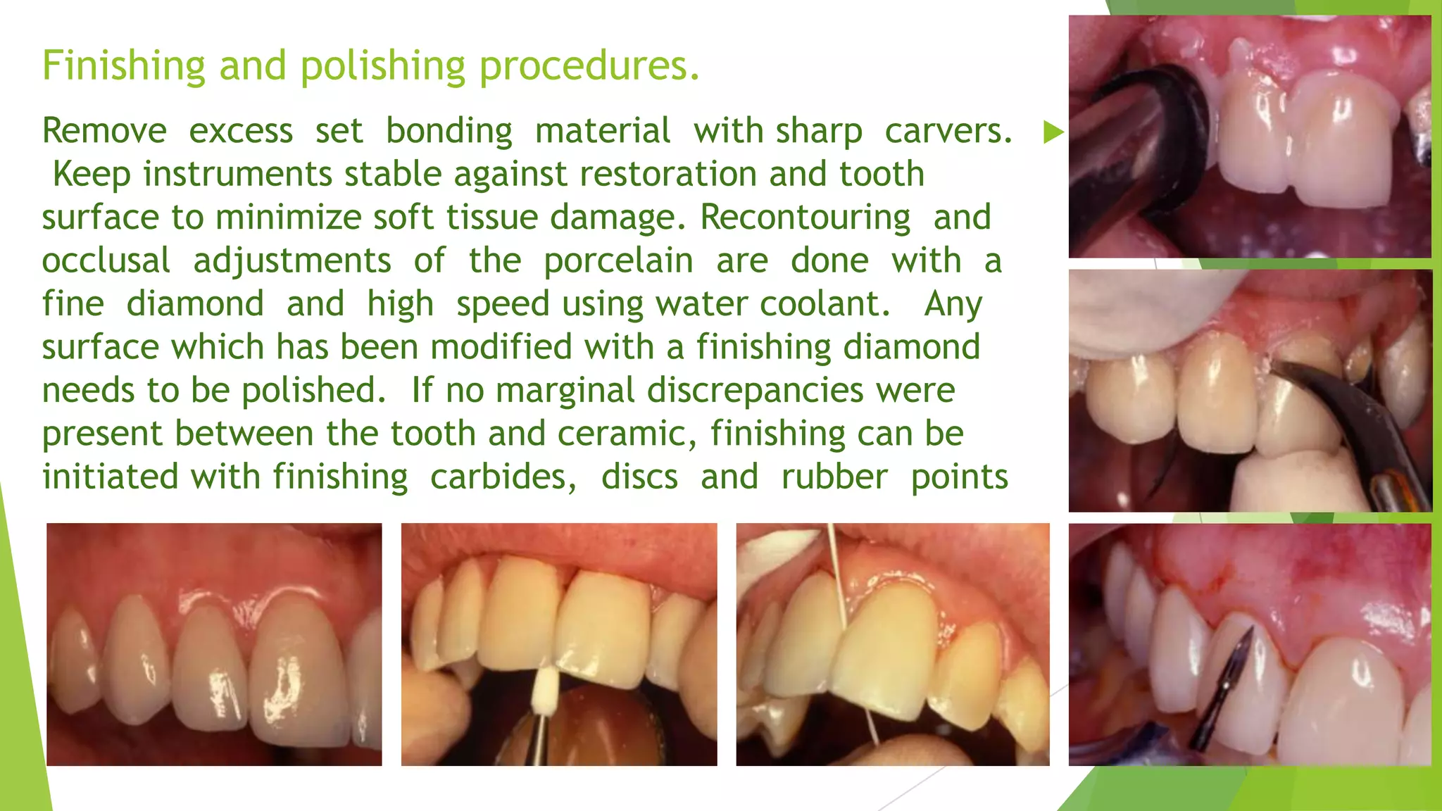 the Veneer step by step | PPTX