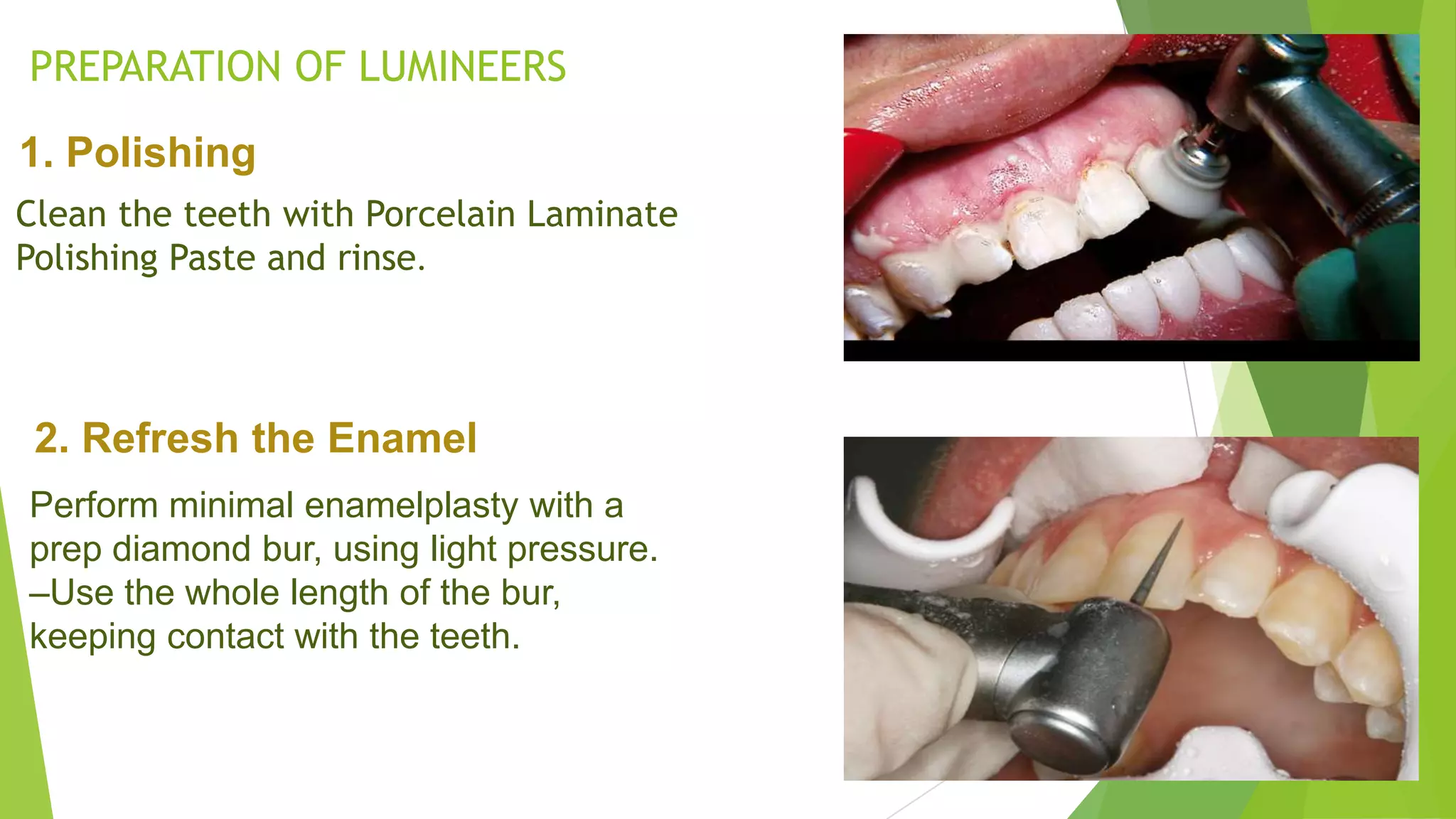 the Veneer step by step | PPTX