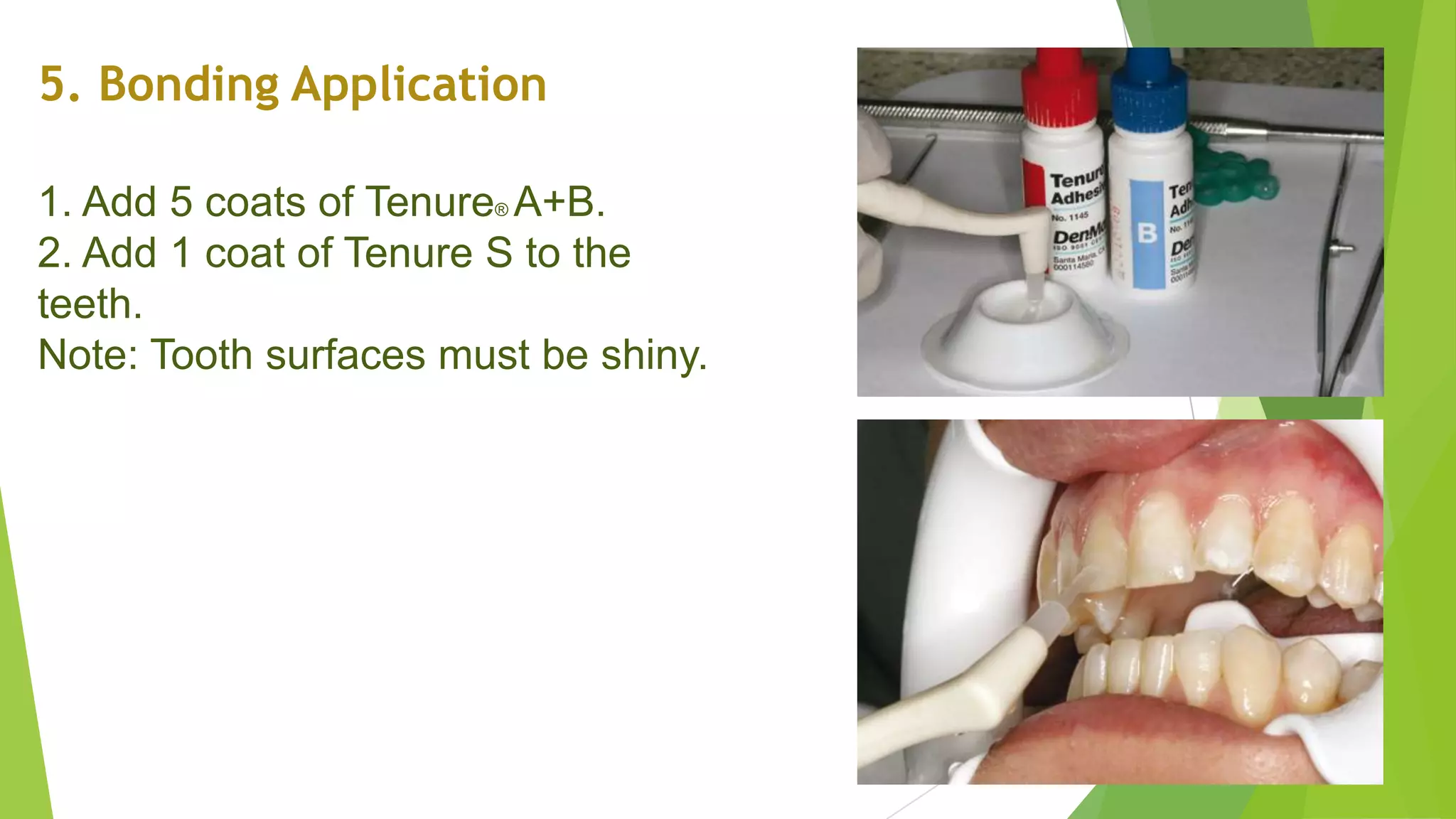 the Veneer step by step | PPTX