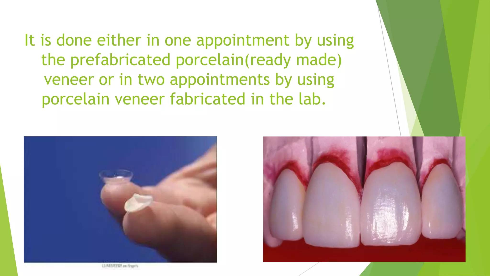 the Veneer step by step | PPTX