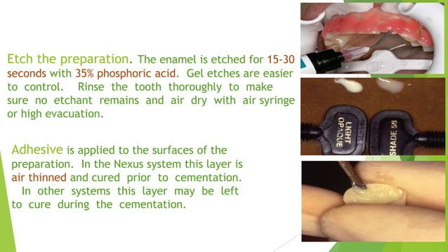 the Veneer step by step | PPTX | Oral care | Personal Care