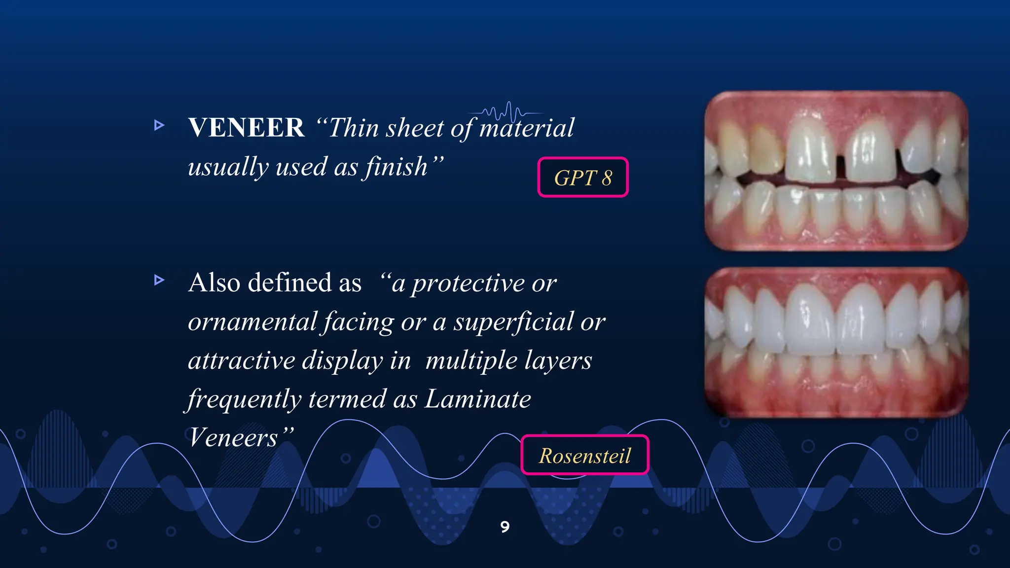 Veneer Materials.pptx conservative dentistry | PPTX