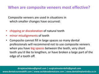 Veneers | composite veneering | porcelain veneering | smile designing ...