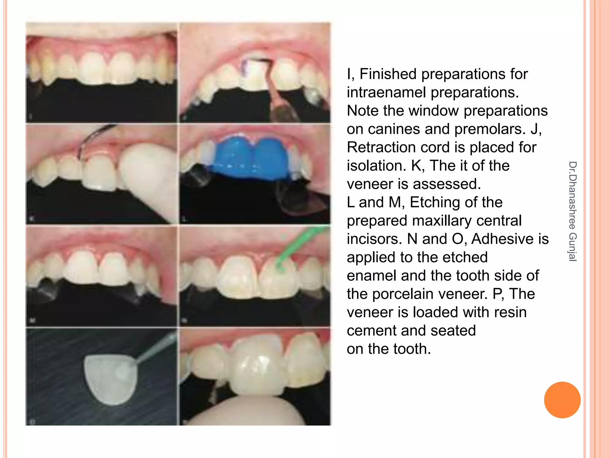 Veneers Dr. Dhanashree Gunjal | PPTX