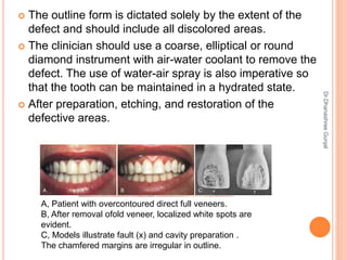 Veneers Dr. Dhanashree Gunjal | PPTX