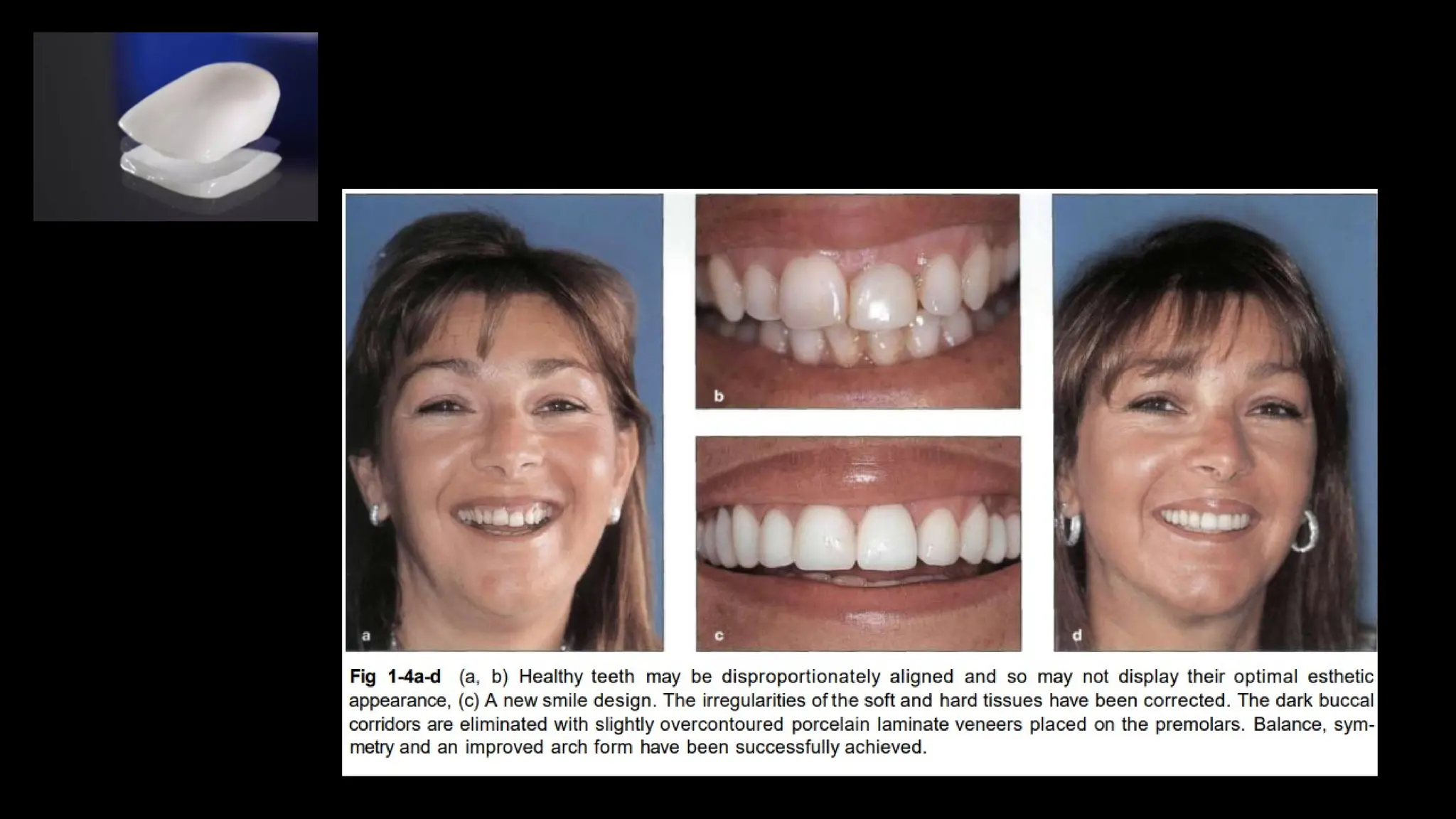 VENEERS, introduction and bonding protocols.pptx