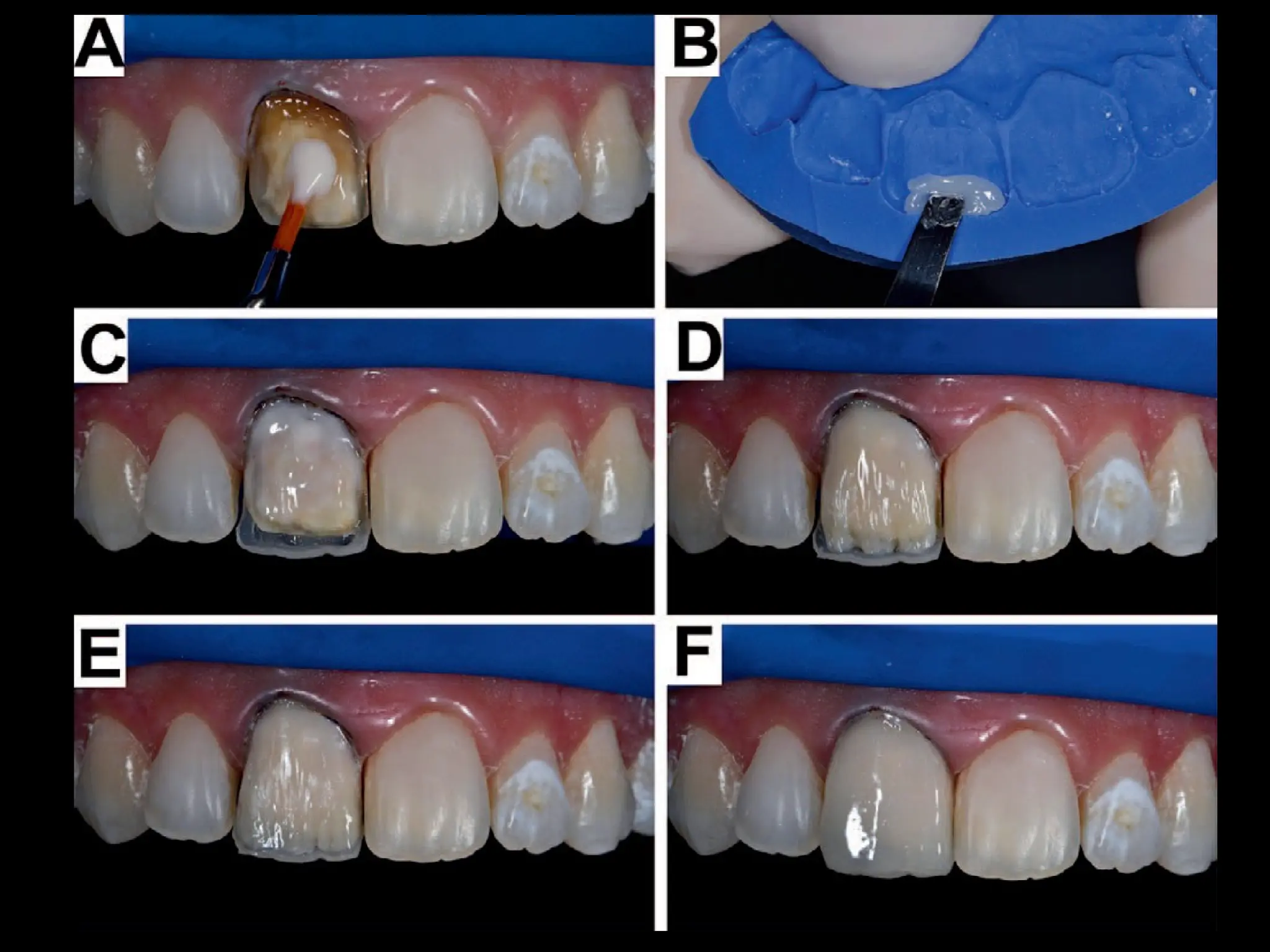 Veneers in conservative dentistry and endodontics | PPTX