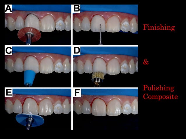 Veneers in conservative dentistry and endodontics | PPTX