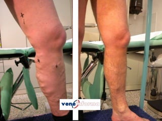 Big Varicose Veins treated with CHIVA Method | PPTX | Heart and ...